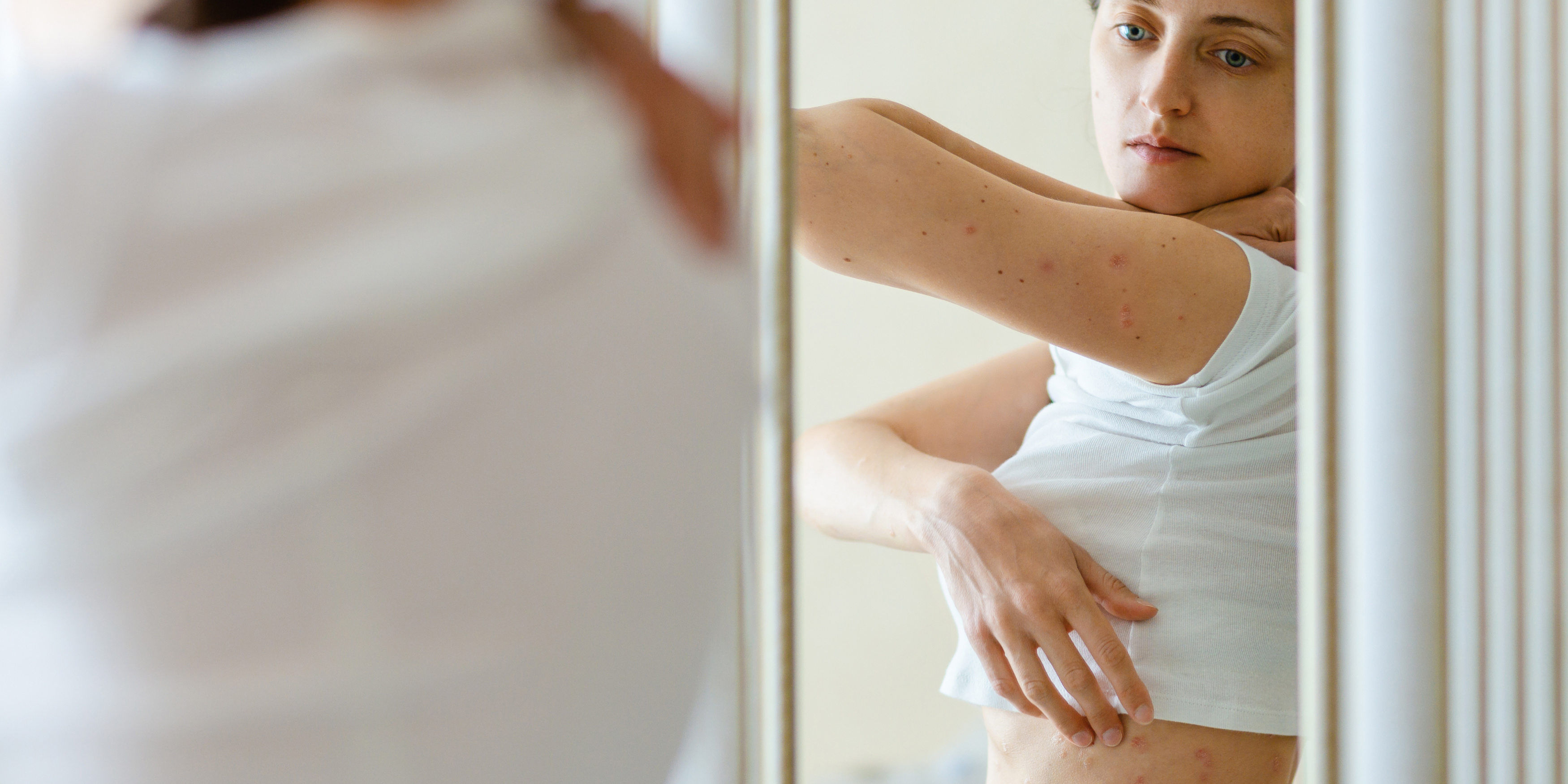 Stress rash: Causes, symptoms, and treatments