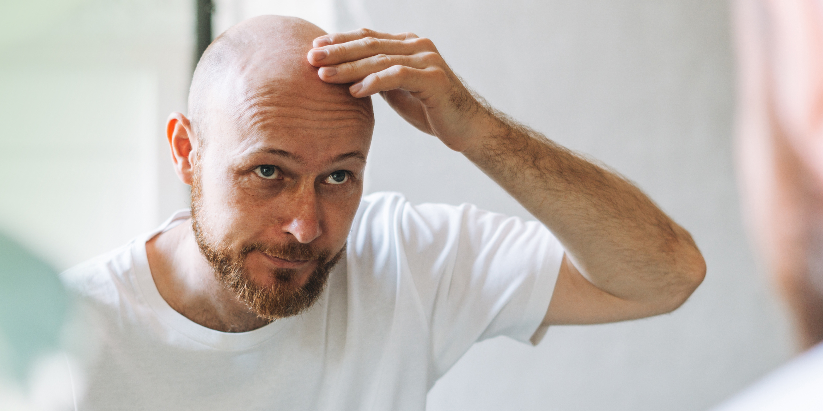 Understanding Male Pattern Baldness Causes And Treatments